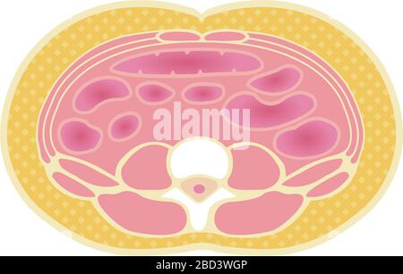 Type of obesity illustration. Abdominal sectional View. (visceral fat ...