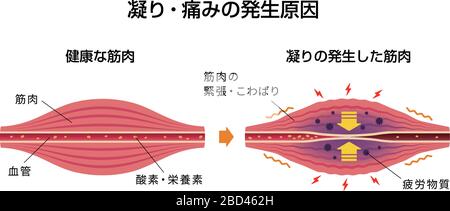 Cause of muscle's stiffness and pain illustration (3 steps Stock Vector ...