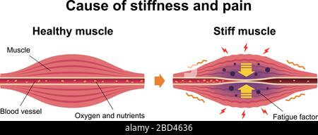 Cause of muscle's stiffness and pain illustration (3 steps Stock Vector ...