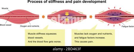 Cause of muscle's stiffness and pain illustration (3 steps Stock Vector ...