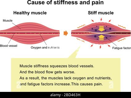 Cause of muscle's stiffness and pain illustration (3 steps Stock Vector ...