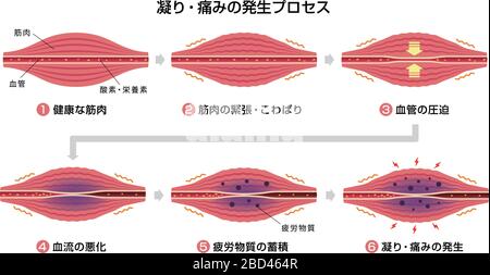 Process of muscle's stiffness and pain illustration ( 6 steps Stock ...