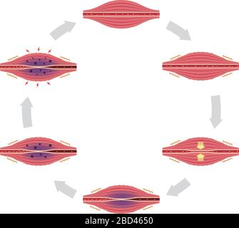 Process of muscle's stiffness and pain illustration ( 6 steps Stock ...