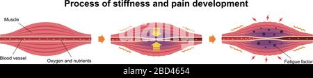 Cause of muscle's stiffness and pain illustration Stock Vector Image ...
