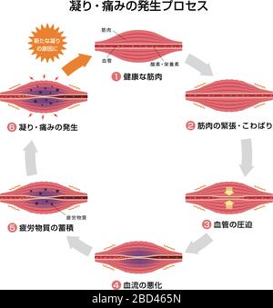 Process of muscle's stiffness and pain illustration ( 6 steps Stock ...
