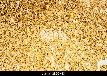 Lues, syphillis of the liver tissue 200x Stock Photo - Alamy