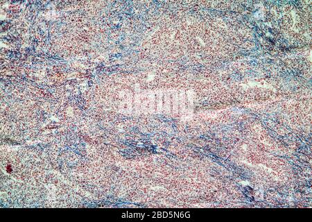 Blood cancer spleen Diseased tissue 100x Stock Photo - Alamy