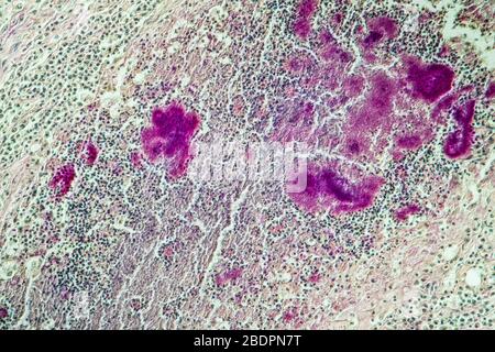 Actinomyces in the jaw Diseased tissue 200x Stock Photo - Alamy