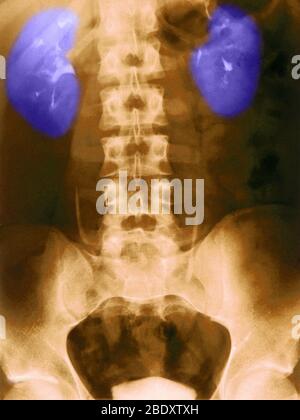 Normal Xray of Urinary Bladder Stock Photo - Alamy