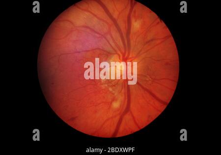 Fundus camera image of the retina of a normal eye, showing the ...