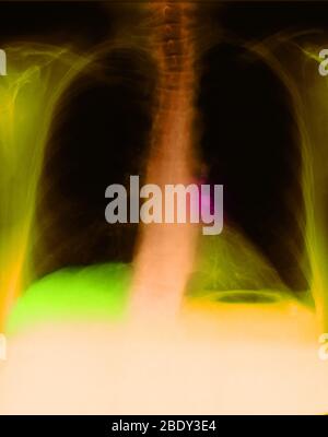 X-ray of Calcified Hilar Lymph Nodes Stock Photo - Alamy