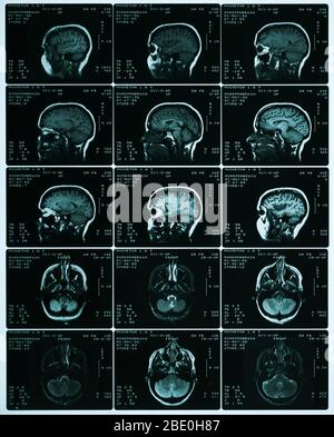 Normal brain, MRI scans Stock Photo - Alamy
