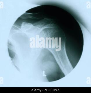 Arthrogram of Left Shoulder Stock Photo - Alamy