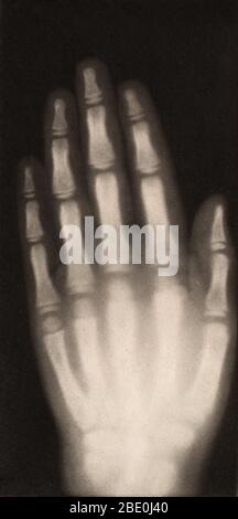 Josef Maria Eder Photography of the hand of an 8-year girl (remains of ...