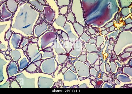 Goiter with colloid thyroid disease 100x Stock Photo - Alamy