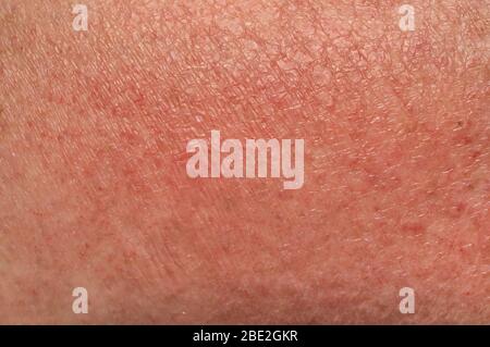 Skin rash or sun allergy Stock Photo - Alamy