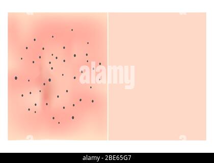 Skin texture with black dots of acne. Before After acne. Skin ...