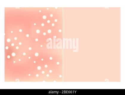 Skin texture with black dots of acne. Before After acne. Skin ...