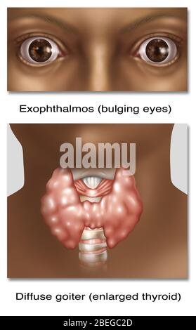 Toxic diffuse goiter, Flajani-Basedow-Graves' disease. 3D illustration ...