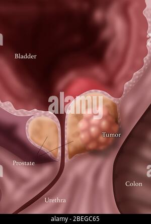 Prostate Cancer, Illustration Stock Photo - Alamy