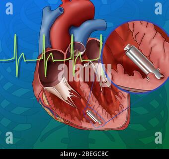 Leadless Pacemaker, Illustration Stock Photo - Alamy