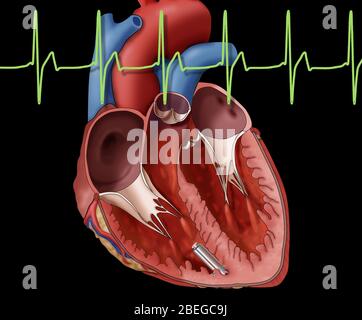 Leadless Pacemaker, Illustration Stock Photo - Alamy