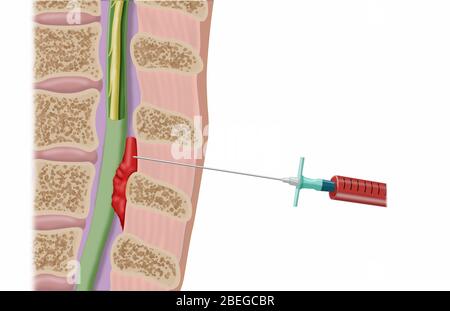 Epidural Blood Patch Procedure, Illustration Stock Photo - Alamy