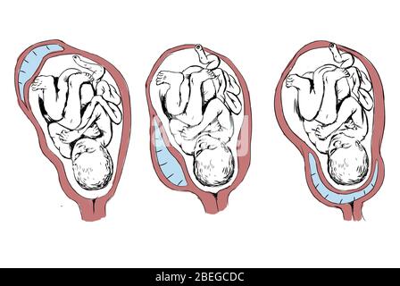 Placenta Previa, Illustration Stock Photo - Alamy