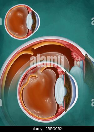 Torn Retina, 2D Illustration Stock Photo - Alamy
