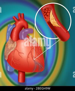 Heart Attack Showing Blood Clot Stock Photo - Alamy