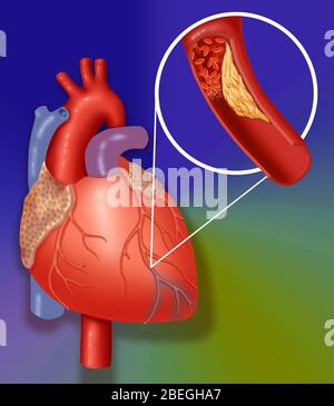 Heart Attack Showing Blood Clot Stock Photo - Alamy