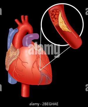 Heart Attack Showing Blood Clot Stock Photo - Alamy