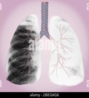 Anatomy of the bronchus and bronchial tubes Stock Photo - Alamy