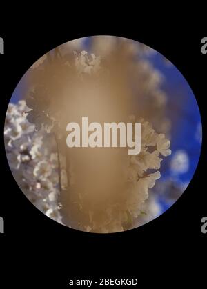 Cataracts, Patient's View Stock Photo - Alamy