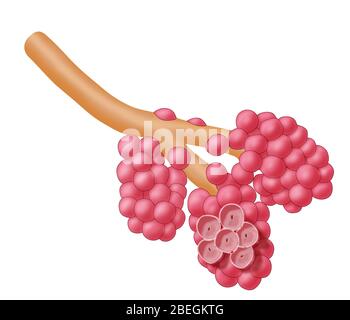 Alveoli Damaged By Emphysema Stock Photo - Alamy