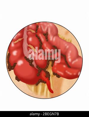 Inflamed appendix, illustration Stock Photo - Alamy