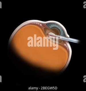 Lens Replacement Surgery Stock Photo - Alamy
