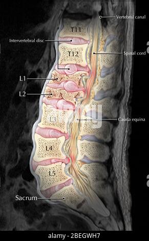 COMPRESSION FRACTURE, MRI Stock Photo - Alamy