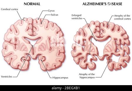 Alzheimer's Disease Brain Comparison Stock Photo - Alamy