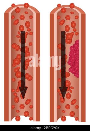 Thrombus. Illustration of a thrombus, an abnormal blood clot formed ...