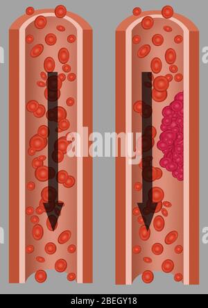 Normal Artery Blood Flow and healthy arteries with no Plaque as a ...