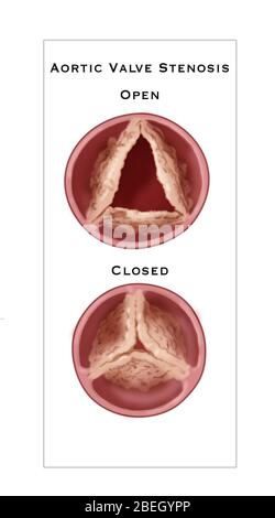 Illustration of aortic valve stenosis, a type of valvular heart Stock ...
