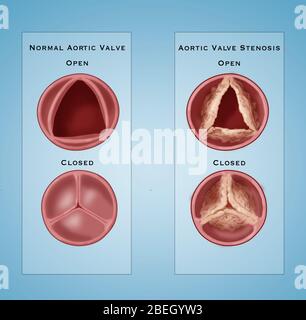 Illustration of aortic valve stenosis, a type of valvular heart Stock Photo: 103991680 - Alamy