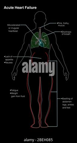 Acute Heart Failure Stock Photo - Alamy