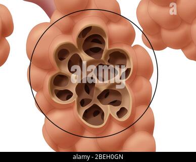 Alveoli Damaged By Emphysema Stock Photo - Alamy