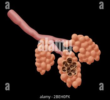 Alveoli Damaged By Emphysema Stock Photo - Alamy