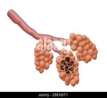 Alveoli Damaged By Emphysema Stock Photo - Alamy