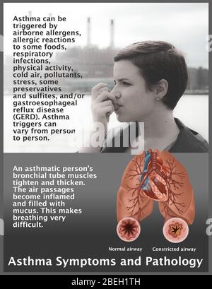 Asthma Pathology. An illustration of lungs with a normal airway (left ...