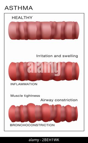 Asthma, Normal bronchiole, asthmatic bronchiole with ...