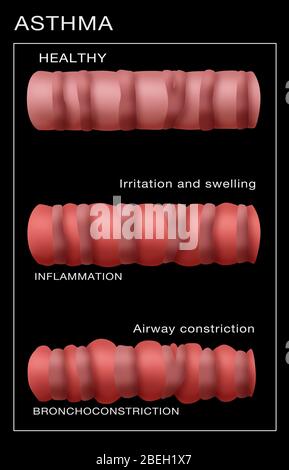 Asthma, Normal bronchiole, asthmatic bronchiole with ...